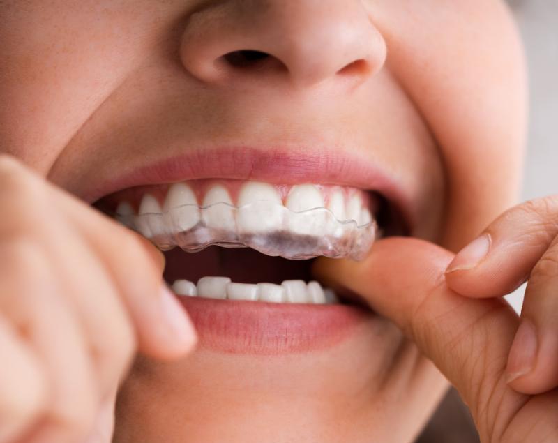 How to Fit Clear Mouth Guard | Oral Mart One-Layer Teeth Grinding ...